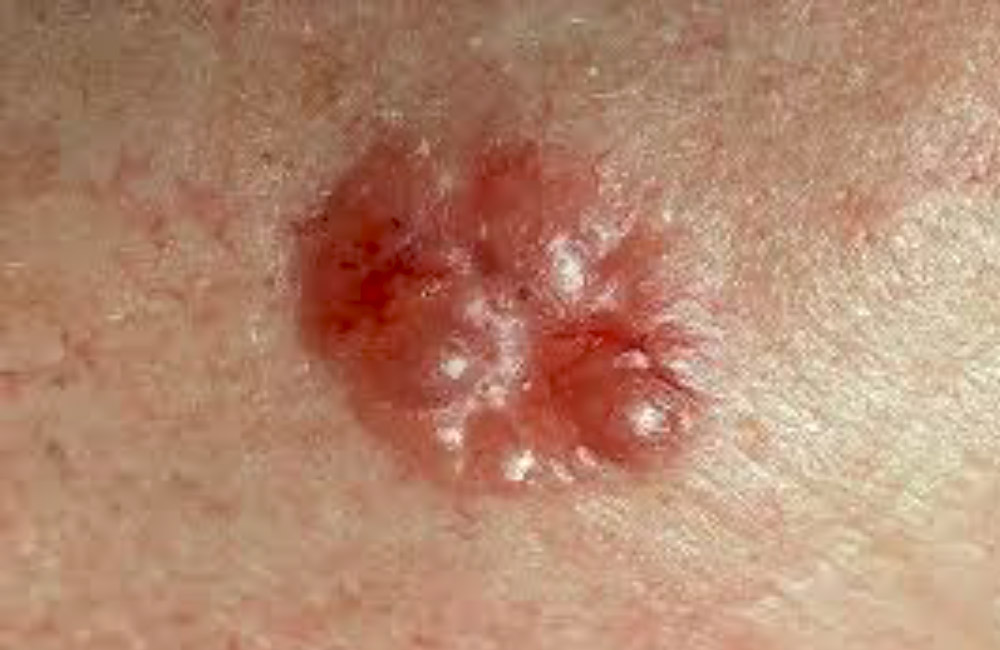 Hautchirurgie ROGY Wien – Vom Muttermal bis zum Hautkrebs.